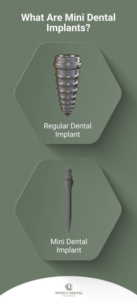 What are Mini Dental Implants? - Dentist Hawthorn